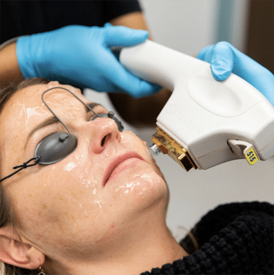 BBL Laser Treatment | Broad Band | Madison WI & Verona